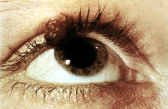 Базалиома кожи - что это за болезнь и как ее лечить? - Паразиты и ...